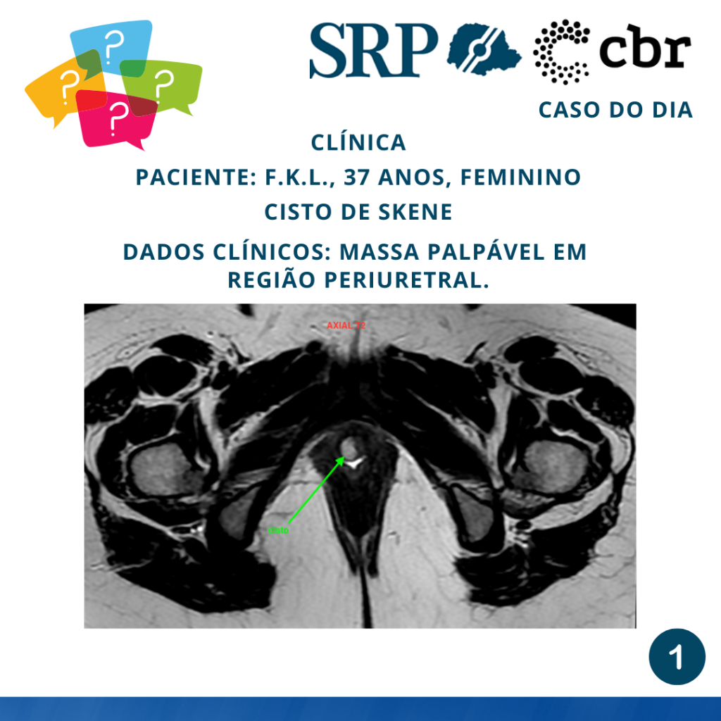 Caso do Dia – Cisto de Skene | Sociedade de Radiologia do Paraná