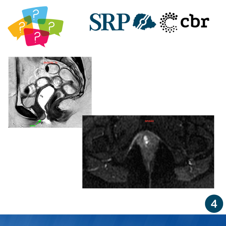 Caso do Dia – Cisto de Skene | Sociedade de Radiologia do Paraná