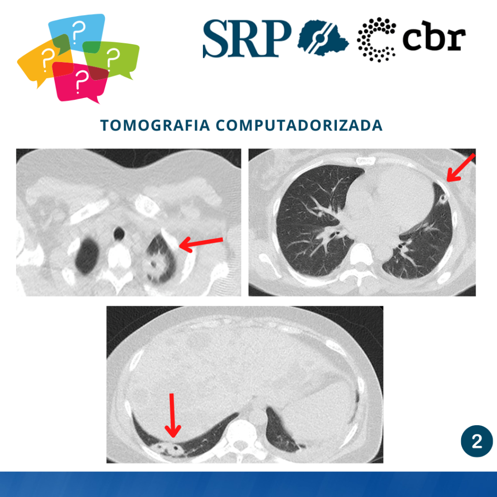 Caso do Dia – Êmbolos Sépticos Pulmonares | Sociedade de Radiologia do ...